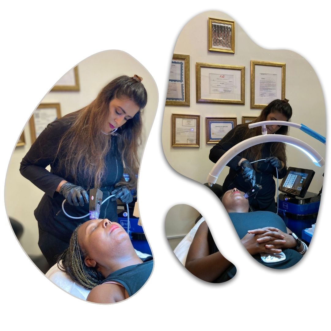 RF Micro needling – Brows By VJ